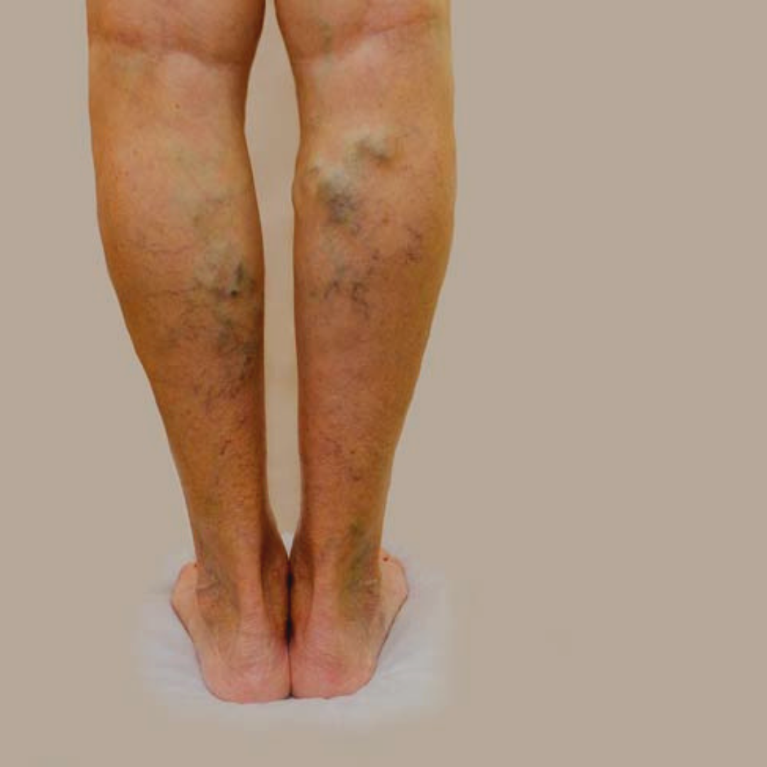 O Que Voc Sabe Sobre Trombose Venosa E Arterial Centro O Que Voc Sabe Sobre Trombose Venosa E Arterial Centro